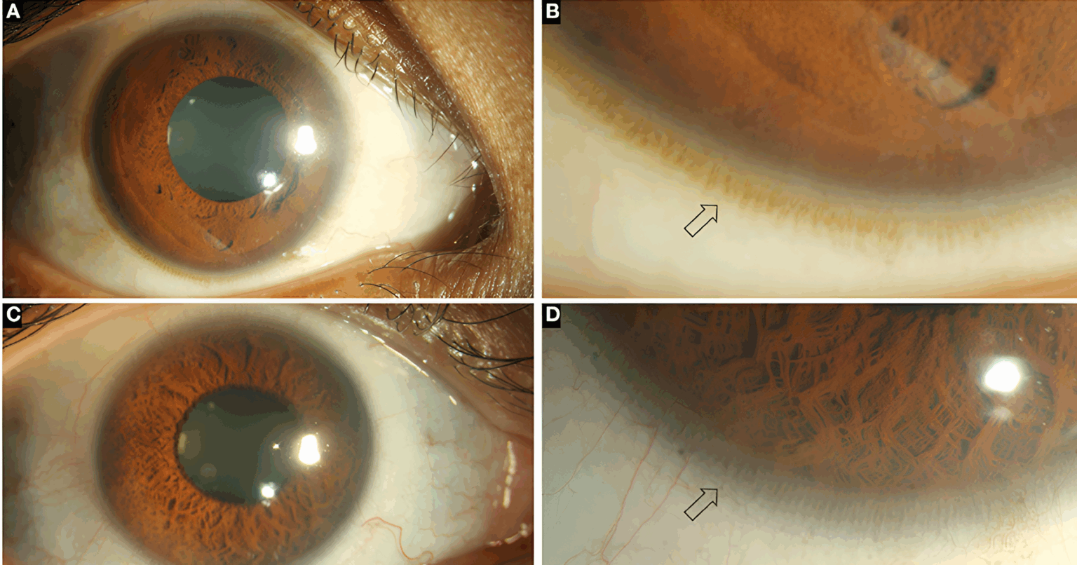 Stem Cells Restore Vision — A Breakthrough for Millions – Engineerine